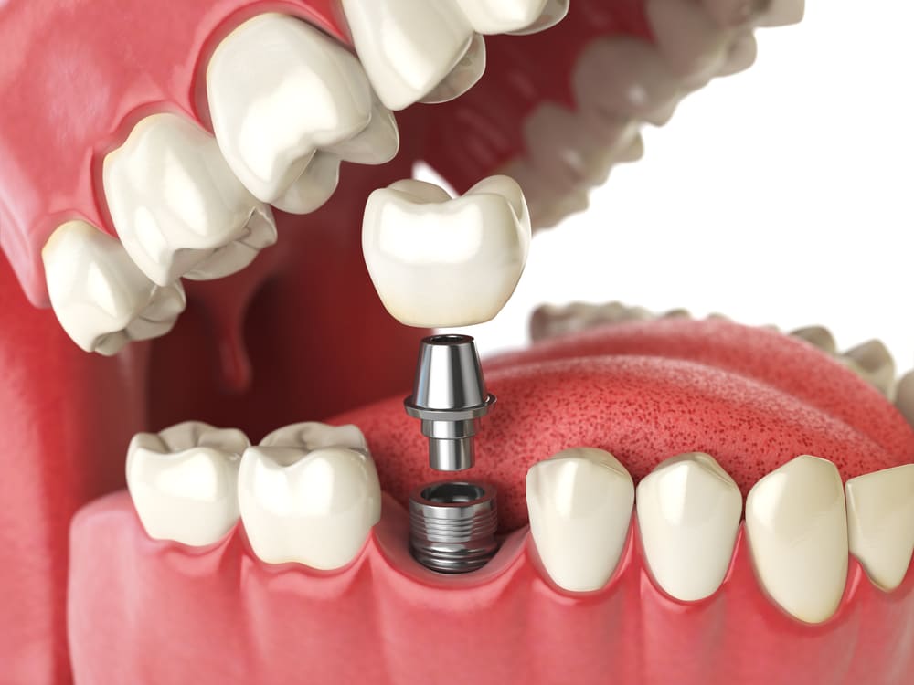 Dental Implants in Edmonton | Meadowleaf Dental